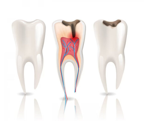 Root Canal Therapy Vs. Tooth Extraction | Dental Care Burlington